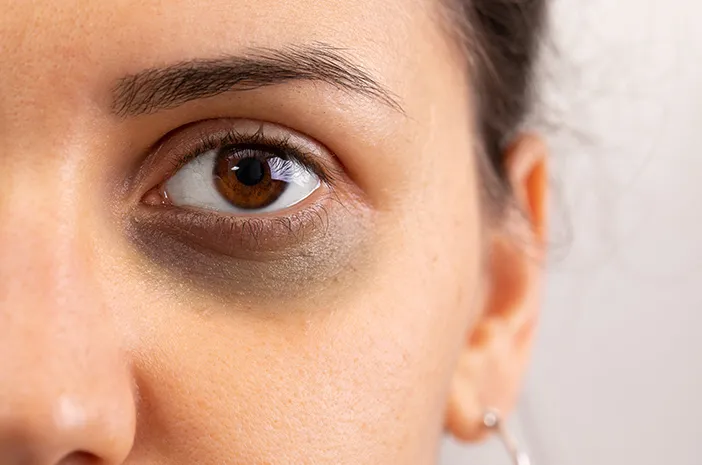 Mata Hitam: Mengatasi Pembengkakan dan Memar di Area Mata | VIO Optical ...